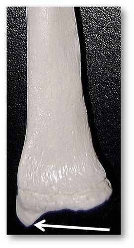 Radius Ulna Bone Markings Flashcards Quizlet