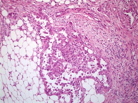 Endometrial Carcinoma Transcoelomic Spread Pathology Image