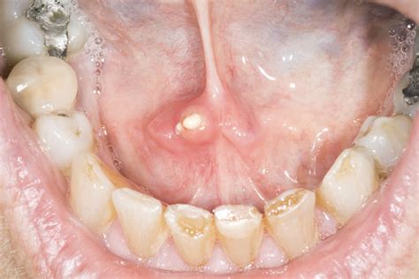 Sublingual Gland Cancer