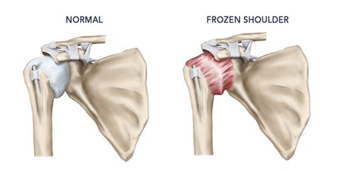 Hombro congelado Qué es y cómo tratar la capsulitis adhesiva