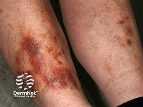 Capillaritis Images