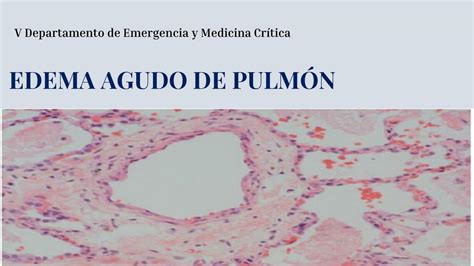 Edema Agudo de Pulmón Gisself Diaz uDocz