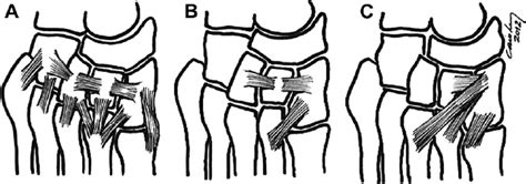 Ligaments Of The Intercuneiform And Tarsometatarsal Joints A