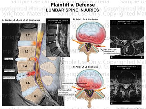 Disc Bulges Stenosis L3 4 L4 5 MotionLit