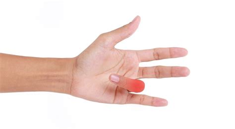 Trigger Finger Stenosing Tenosynovitis Carella Klinika Chirurgii