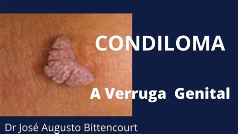 CONDILOMA VERRUGAS GENITAIS YouTube