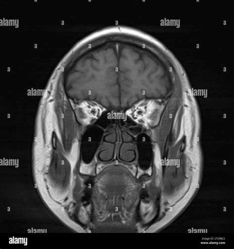 Healthy Brain Mri Scan Stock Photo Alamy
