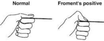 Tardy Ulnar Nerve Palsy Cause Symptom S Physiotherapy Treatment