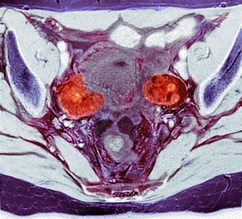 Ovarian Cancer Ct Scan With Contrast