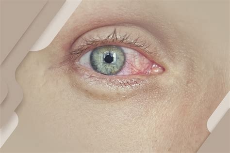 Alergias também afetam os olhos Oftalmocasa