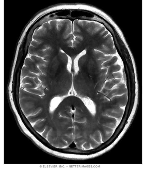 T Weighted Mri