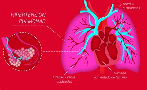 La hipertensión pulmonar una enfermedad rara