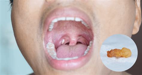 Tratamiento Del Cáncer De Amígdalas