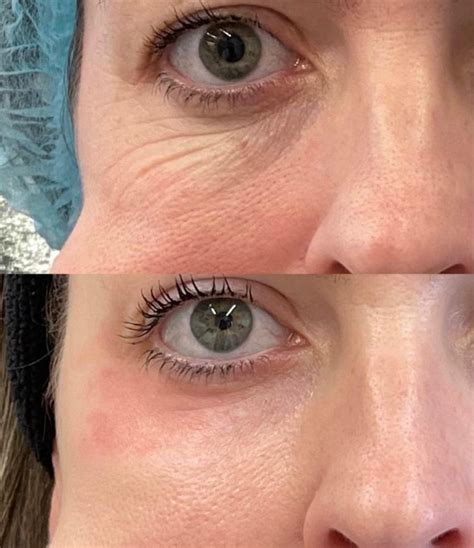 Line Skin Peeling de Fenol Máscara Clínica Bergmann
