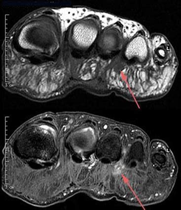 Morton S Neuroma Treatment Gallery Tucson S Podiatric Medicine