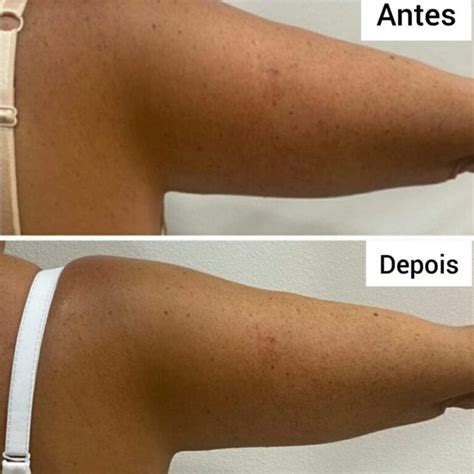 Gordura Localizada nos Braços Antes e Depois Fit Body Estética
