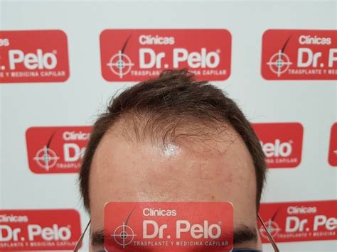 Tratamiento capilar con mesoterapia Láser capilar LedHair