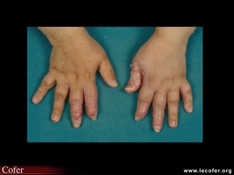 Psoriasis des doigts Diapothèque du COFER