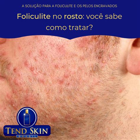 Foliculite No Rosto Você Sabe Como Tratar