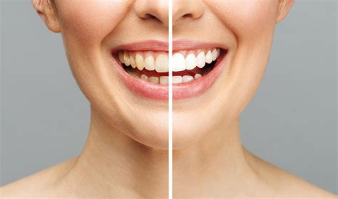 Diş Kaplama arşivleri Dentium Ağız ve Diş Sağlığı Polikliniği