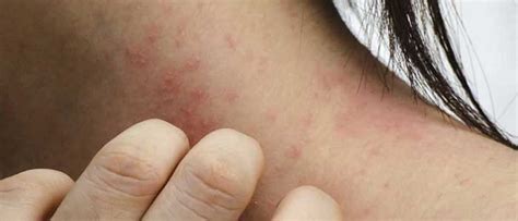 Uyuz Hastalığı Nedir Nedenleri Belirtileri Korunma Yolları ve