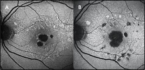 Practice Considerations Regarding Treatment Of Geographic Atrophy