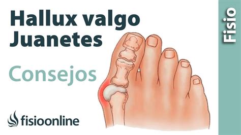 Juanete o Hallux valgus Cómo tratarlo con ejercicios y auto masajes