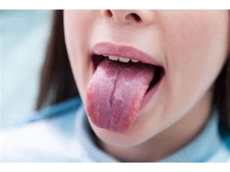 Por qué aparecen manchas en la lengua