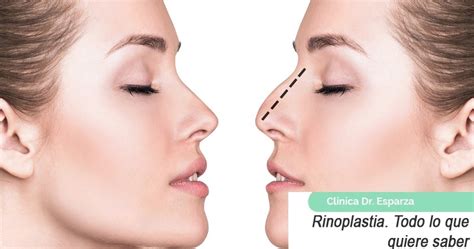 Rinoplastia Todo Lo Que Quiere Saber Dr Esparza