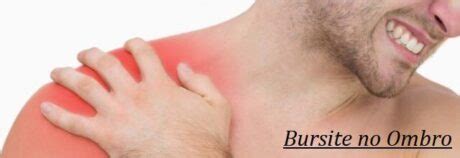 Antiinflamatório para Bursite Como Tratar Nomes