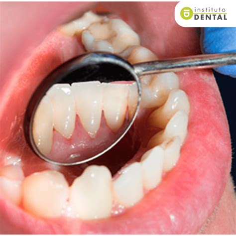 DIFERENCIAS ENTRE RASPADO Y LIMPIEZA DENTAL Instituto Dental Bravo Corpas