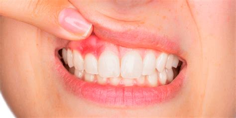 Gengiva Inflamada Conhe A As Causas Mais Comuns Redeplus Odontologia