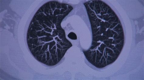 Lung Cancer Screening Mayo Clinic Youtube