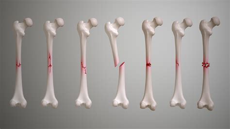 Bone Fracture FI Scientific Animations