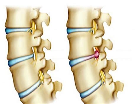 Hernie Discale Service De Neurochirurgie Lariboisi Re