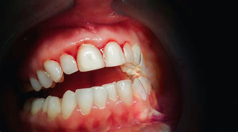 Sabes lo qué es la piorrea Clínica Dental Mediterráneo