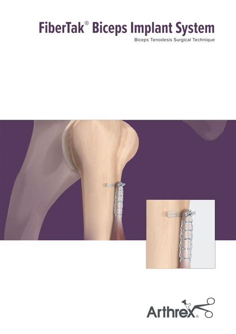PDF FiberTak Biceps Implant System Arthrex DOKUMEN TIPS