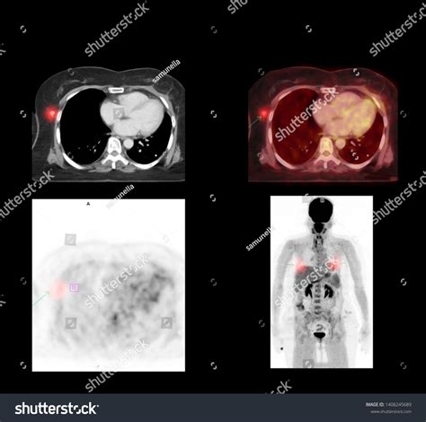 Pet Ct Scan Image Whole Body ilustración de stock 1408245689