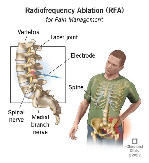 How Long Does Radiofrequency Ablation Last Infrared For Health