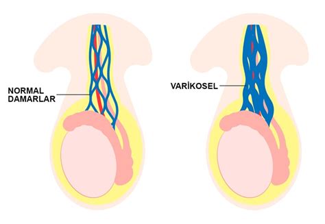 Varikosel Nedir