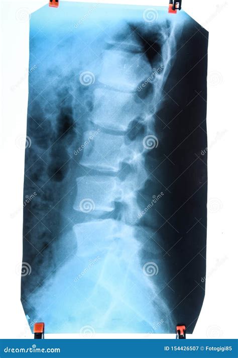 X Rayo De La Espina Dorsal Lumbar Espina Dorsal En Radiograf A Imagen