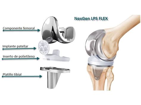 Cirugía de Protesis de Rodilla Cómo se realiza la operación y cómo es