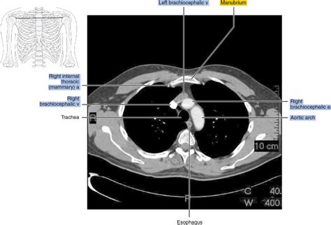 Anatomy Of CT Scans Thoracic Cavity