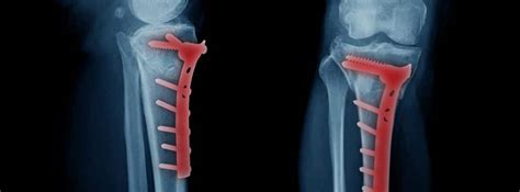 Osteosíntesis tipos materiales y más canalSALUD