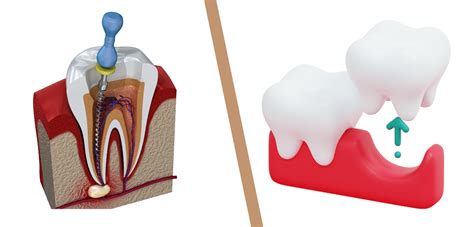 Root Canal Vs Tooth Extraction Which Is Better