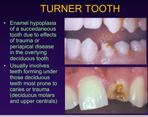 Od Abnormalities Of Teeth Flashcards Quizlet