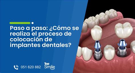 Paso a paso Cómo se realiza el proceso de colocación de implantes