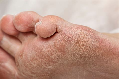 Diabetes Estos son los problemas a la piel que podrían indicar que