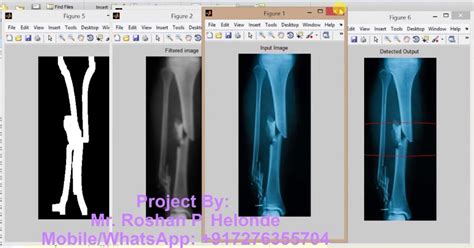 bone fracture detection using image processing matlab project with source code ~ engineering