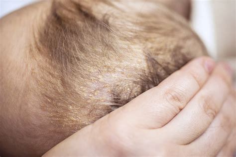 Seborrheic Dermatitis VitalSkin Dermatology
